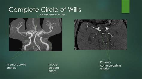 Circle Of Willis Mri Radiology Edu On Twitter Neck Mra Anatomy