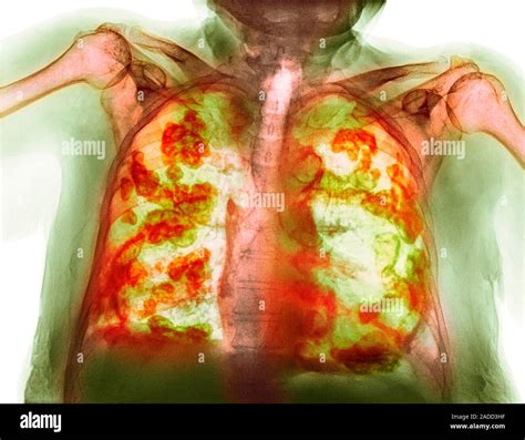 Bilateral Pleural Calcification Coloured X Ray The Pleura Are The