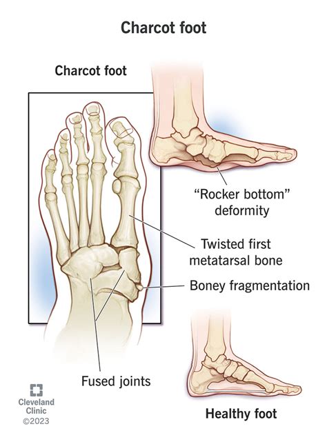 Charcot Foot Symptoms Causes Treatment 42 Off