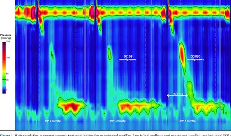 Nutcracker Esophagus High Resolution Manometry At Jennifer Wilkins Blog