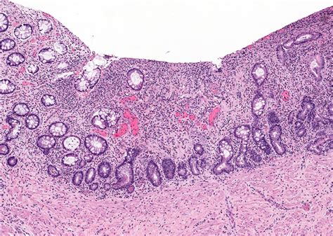 Pathology Outlines Shigella