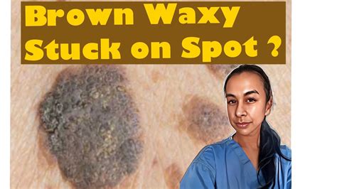 Brown Waxy Spots On Skin Seborrheic Keratosis Explained By A Plastic