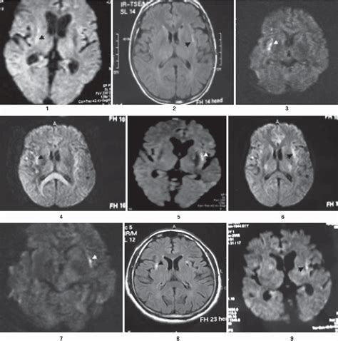 External And Extreme Capsular Stroke Clinical Topographical And