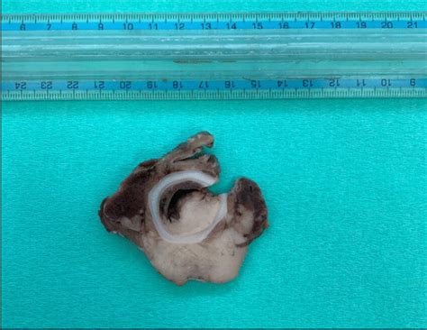 Transversal Section Of The Subglottic Mass Download Scientific Diagram
