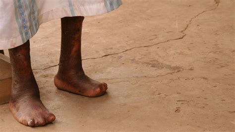 Leprosy How Lepers Have Been Shunned Reviled And Left To Die Daily