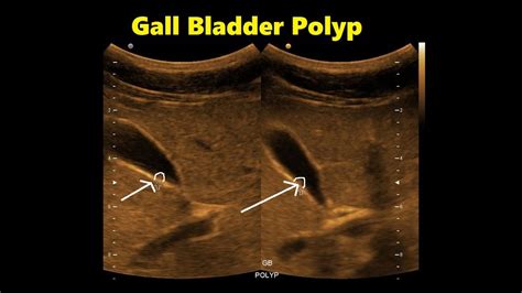 Tiny Gall Bladder Polyp Ultrasound Case 02 Youtube