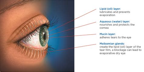 Dry Eye Syndrome Symptoms North Florida Cataract And Vision