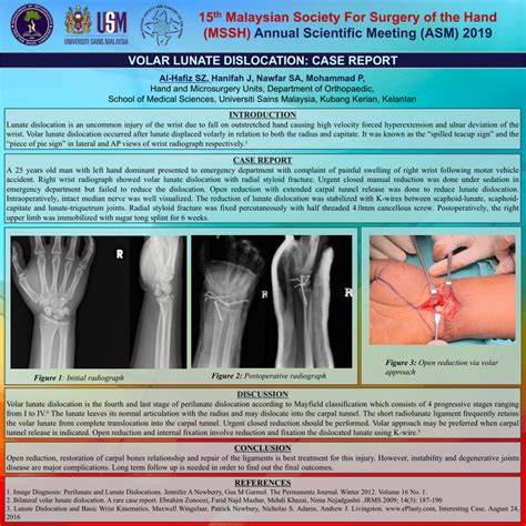 Pdf Volar Lunate Dislocation Case Report