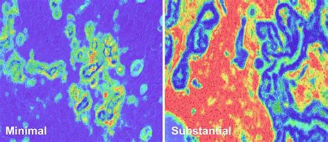 Stromal Disruption Predicts Aggressive Breast Cancer Risk Survival Nci