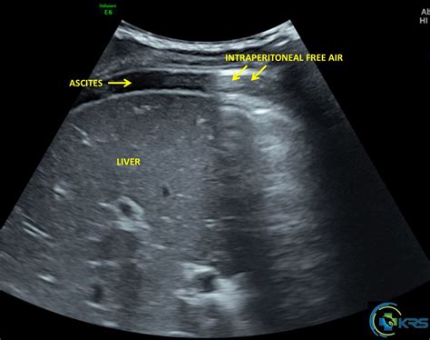 Perforation Peritonitis Drkalirajanscans