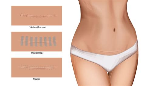 Monofilament Suture Vs Multifilament Top Suture Manufacturer