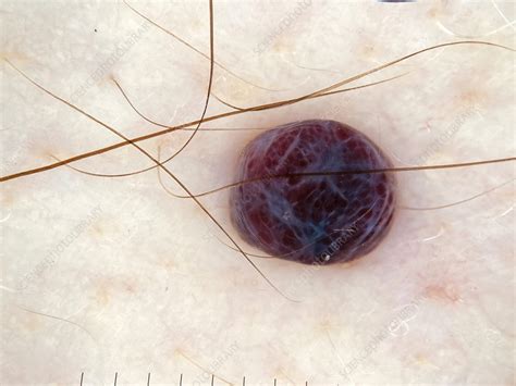 Angioma Dermoscopy Stock Image C0571770 Science Photo Library