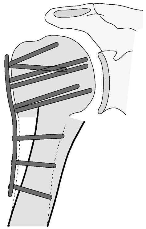 Jcm Free Full Text It Is Always The Same—a Complication