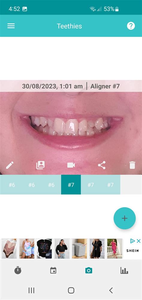 Teeth Moving The Wrong Way Rinvisalign
