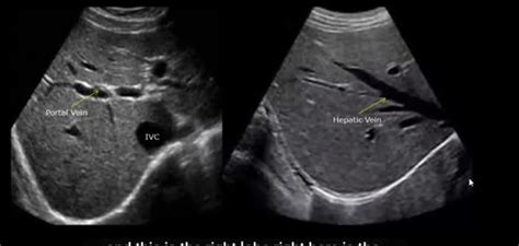 Liver Abnormal V Normal Flashcards Quizlet