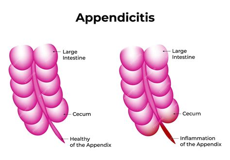 Premium Vector Appendicitis Large Intestine Cecum Healthy And