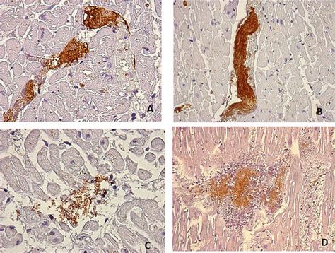 P Selectin Heart Samples Strong Positive Reaction Of Aggregate