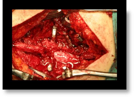 Endoscopic Spine Surgery Why Interlaminarwhy Destandau Techniques