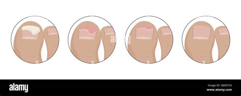 Four Steps Showing Toenail Healing From Onycholysis Medical Condition