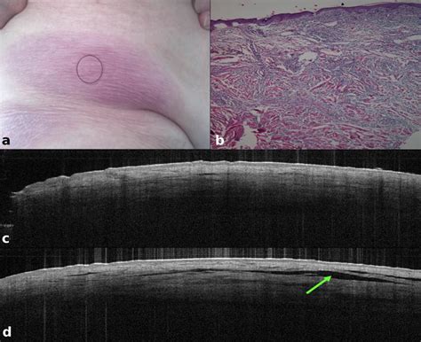 A An Erythematous Patch Identified On The Right Side Of The Upper