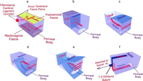 A Normal Support Anatomy Of The Vagina B Vault Prolapse C