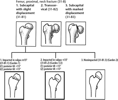 Otaao Classification Of Femoral Neck Fractures Download Scientific Diagram