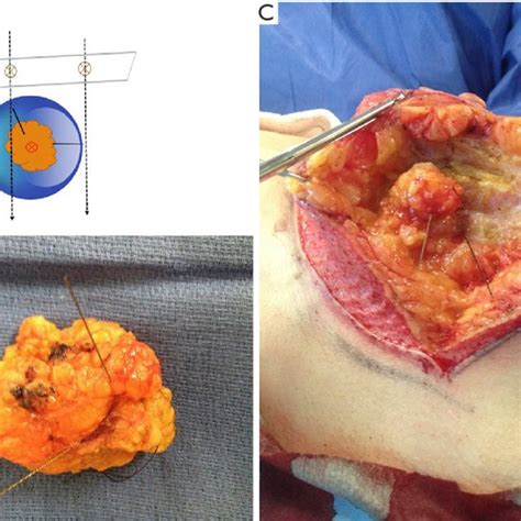 Wire Guided Excision A Sphere Represents The Ideal Theoretical