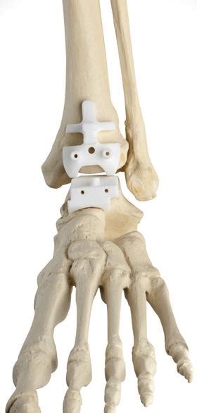 Wrights Prophecy® Inbone® Pre Op Guides For Ankle Replacement At Aaos