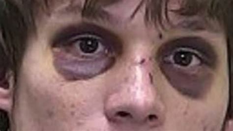 Periorbital Ecchymosis