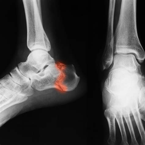 Sprained Ankle Torn Ankle Ligaments Ankle Sprain Physio Pretoria