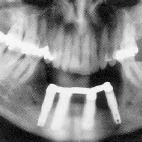B Intraoral View Of The Brånemark Implants Download Scientific Diagram