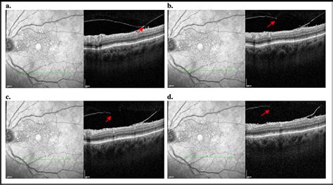 Epiretinal Membrane Exacerbated By Vitreomacular Traction And Anomalous