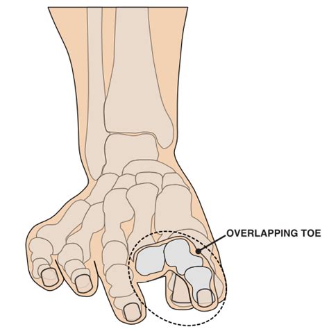 Types Of Lesser Toe Deformities At Bill Voigt Blog