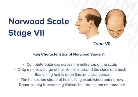 Norwood Scale Stages Of Hair Loss And Treatments Medart Hair