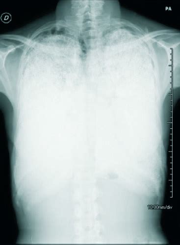Clinical Cases Chest Woman 40 Years Old Diffuse Lung Opacification