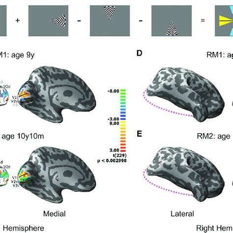 early visual cortex activation in u d in rm1 age 9 years and rm2
