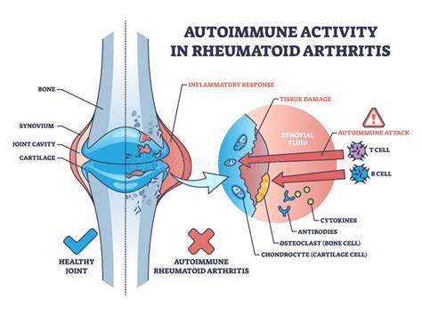 Autoimmune Activity In Rheumatoid Arthritis Skeletal Disease Outline