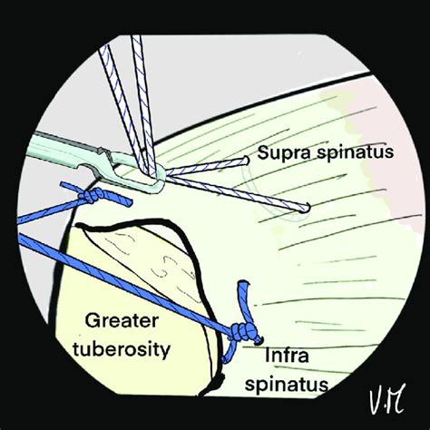 Drawing Of An Arthroscopic Subacromial View From The Posterior Portal Download Scientific