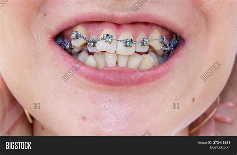 Braces On Upper Jaw Image And Photo Free Trial Bigstock