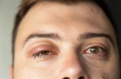 How To Treat A Bacterial Infection On The Eyelid Safely