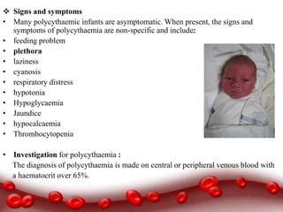 Plethora In Polycythemia Vera Plethora In Polycythemia Vera