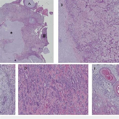 Superficial Parotidectomy From The Referring Hospital For Download