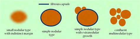 Schema For Subclassification Of Nodular Hcc On Gross Appearance Download Scientific Diagram