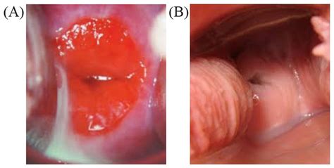 Macroscopical Appearance Of Vaginal Tissue During Speculoscopy From