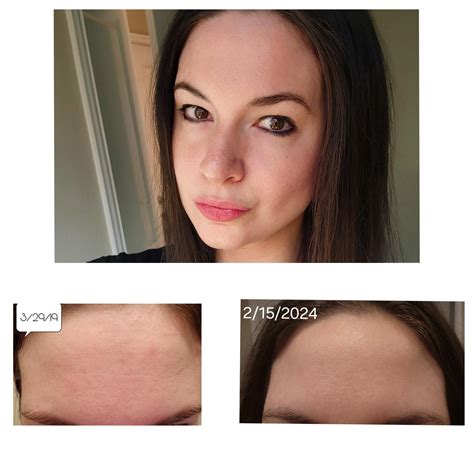 Does Tret Work 5 Year Update Rtretinoin