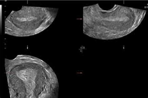Sagittal Uterus Drawing Image Of A Niche Using Transvaginal Ultrasound