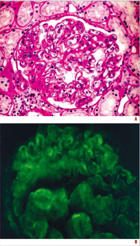 Glomerulonefrite Intersticial Ilustrações Vetores E Clipart De