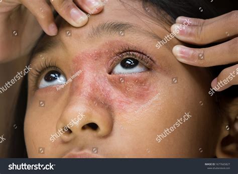 Eczema Circular Rash