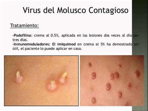Infecciones Ginecologicas