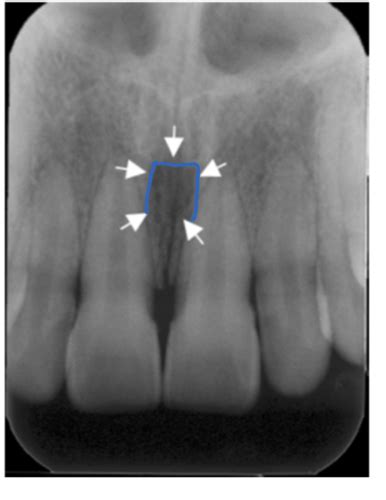 Intermaxillary Suture Radiograph